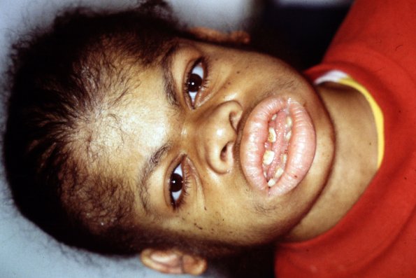 PICT0001 | Corneila Syndrome | Dr. Ken Hashimoto | Wayne State University SOM - Dermatology ...